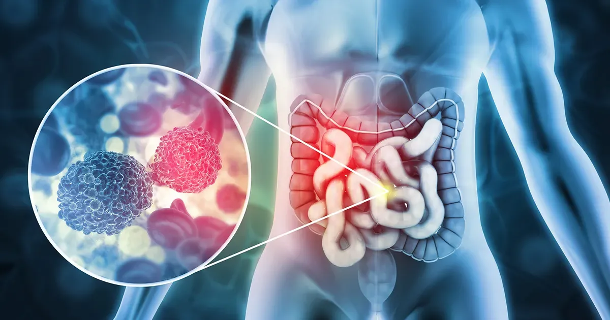 Les symptômes des polypes du côlon à surveiller